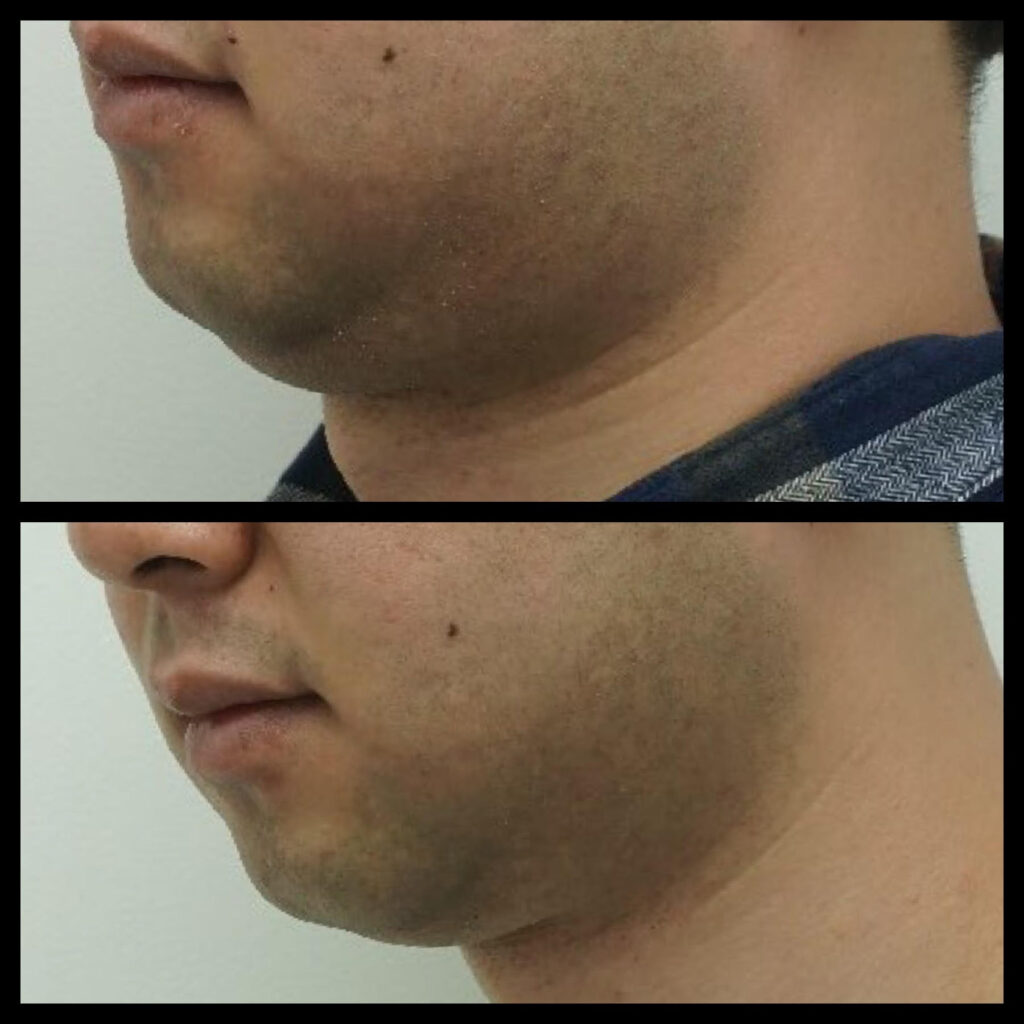 Cryolipolysis | Cosderm & DrV