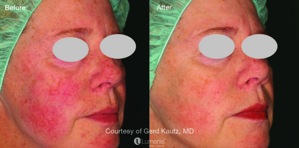 Stellar M22 and Photofabulous | Cosderm & DrV